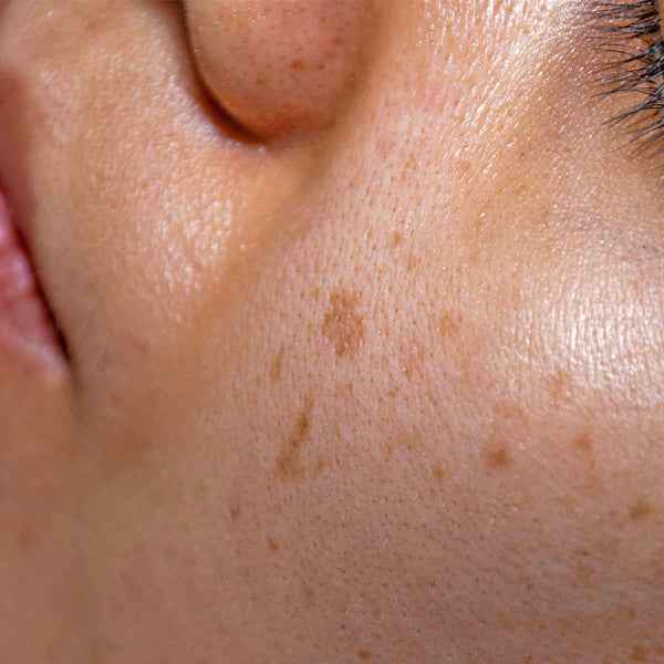 Red Light Therapy for Hyperpigmentation: Can It Help? | Solawave