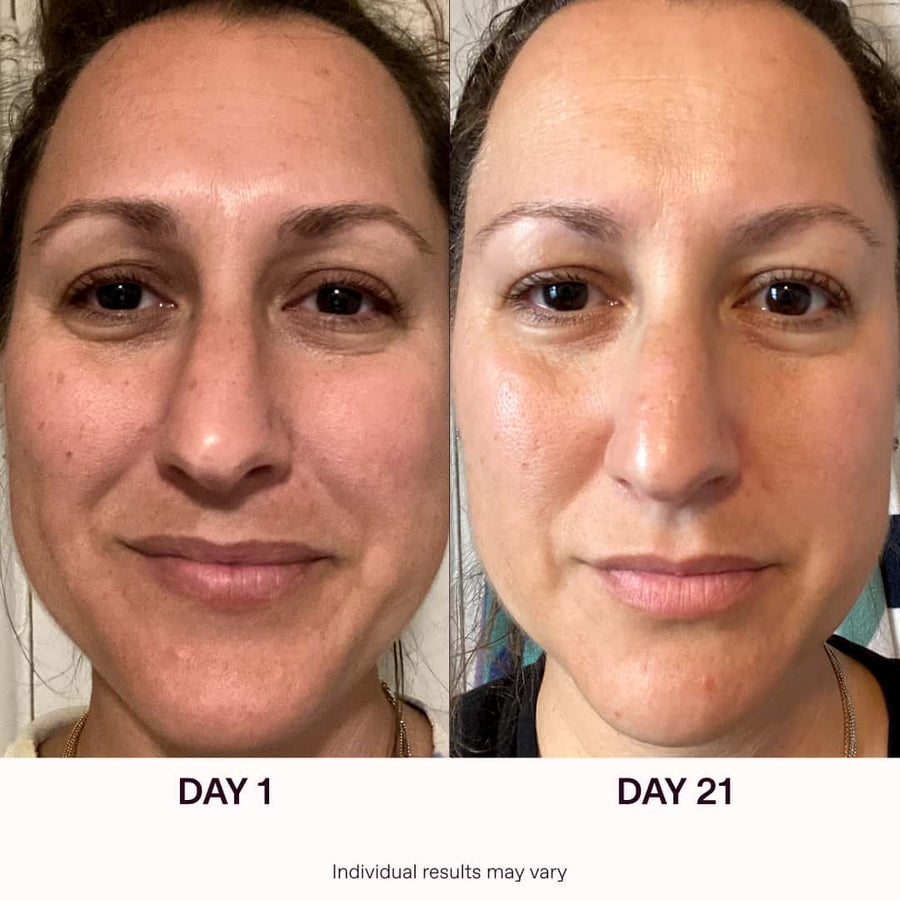 Red Light Therapy Before and After | SolaWave