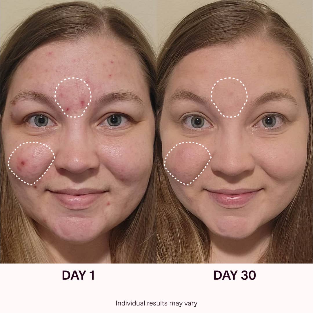 Red Light Therapy Before and After | SolaWave