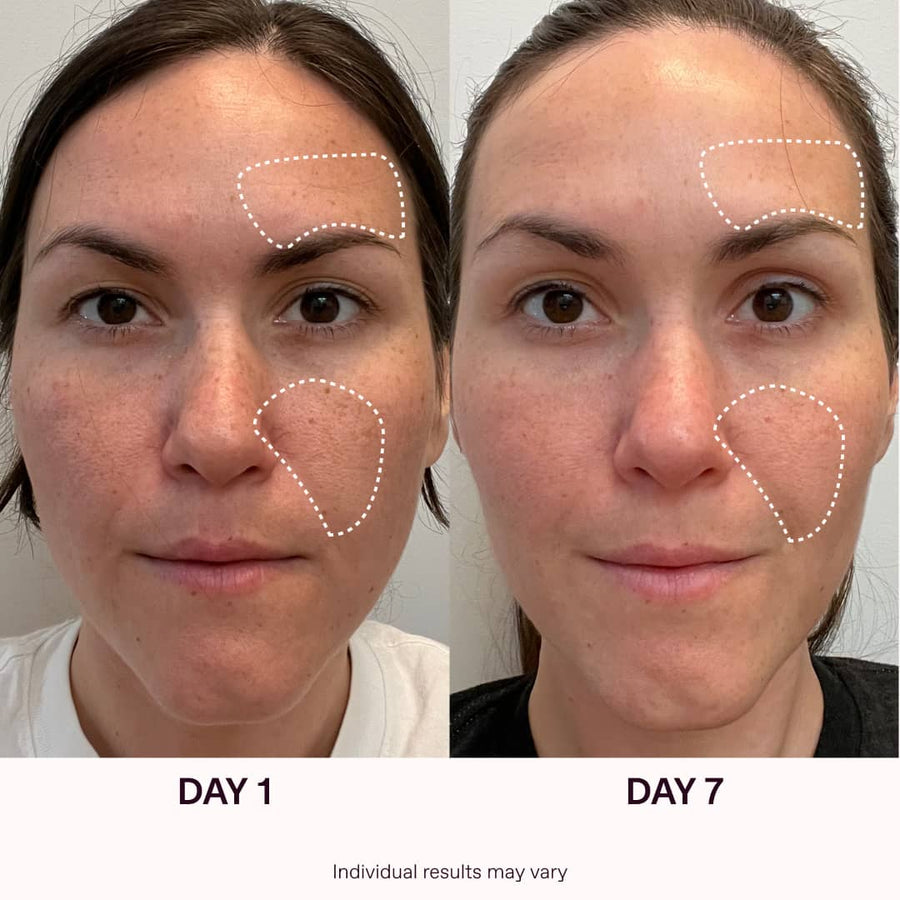 Red Light Therapy Before and After | SolaWave