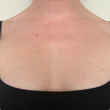 Red Light Neck Mask | Neck And Chest LED Mask | Solawave